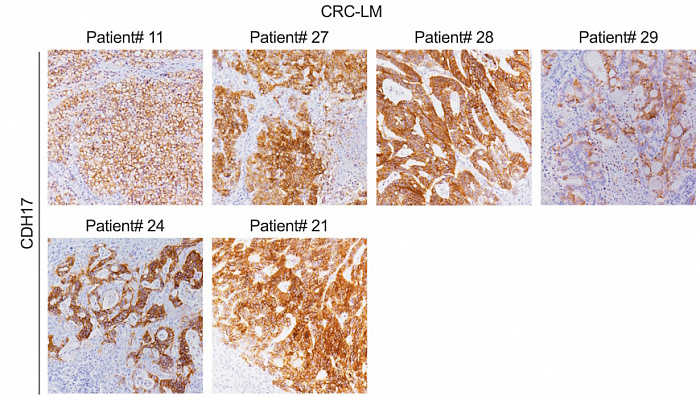 CAR T-клетки против кадгерина-17 борются с метастазами в печени при колоректальном раке — PCR News