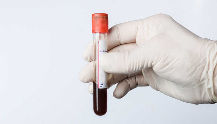 Риск развития кардиомиопатии у людей, перенесших рак в детстве, определили по белкам крови — PCR ...