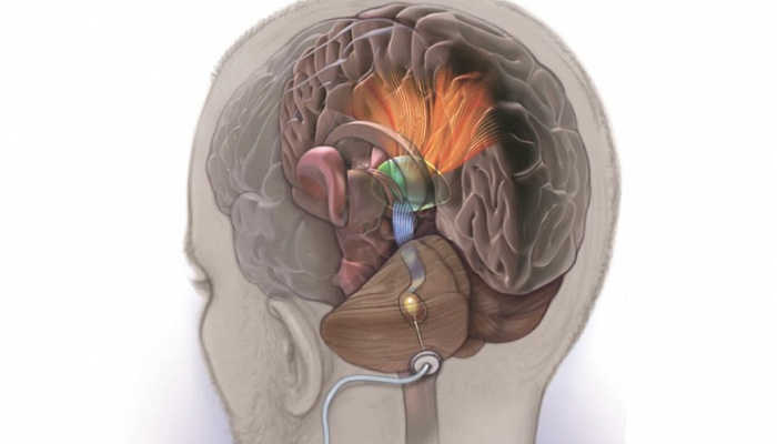 Глубокая стимуляция мозжечка восстановила подвижность рук после инсульта — PCR News